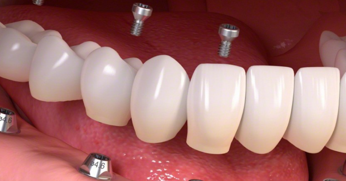 What makes fixed dentures so expensive over snap in dentures?