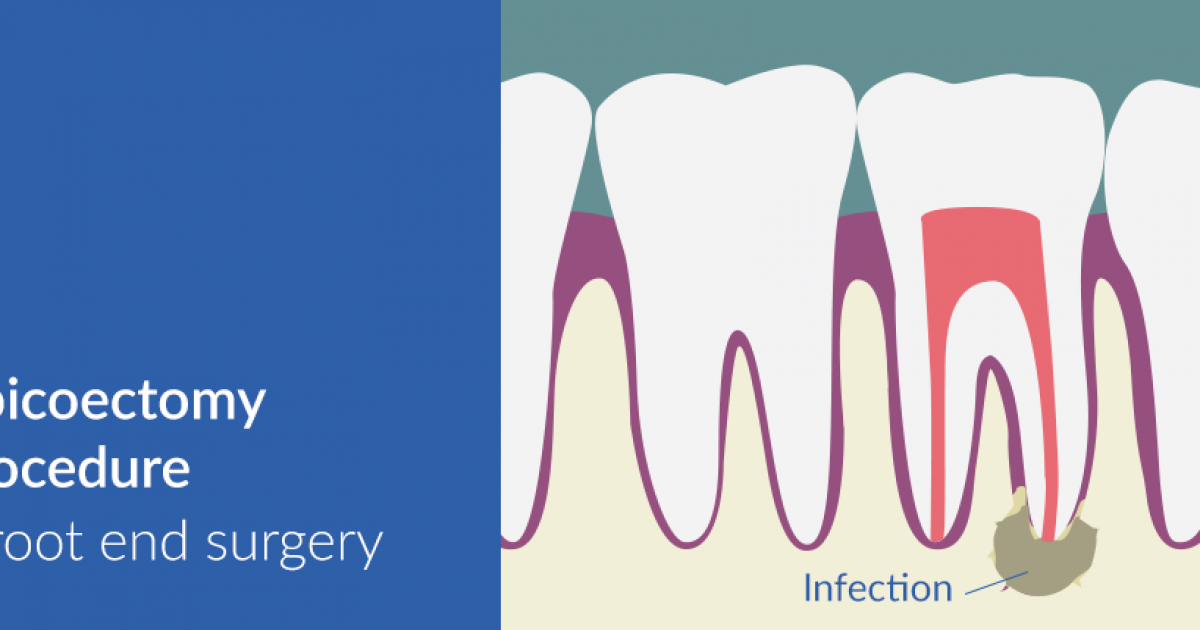 Apicoectomy Procedure: A Root End Surgery