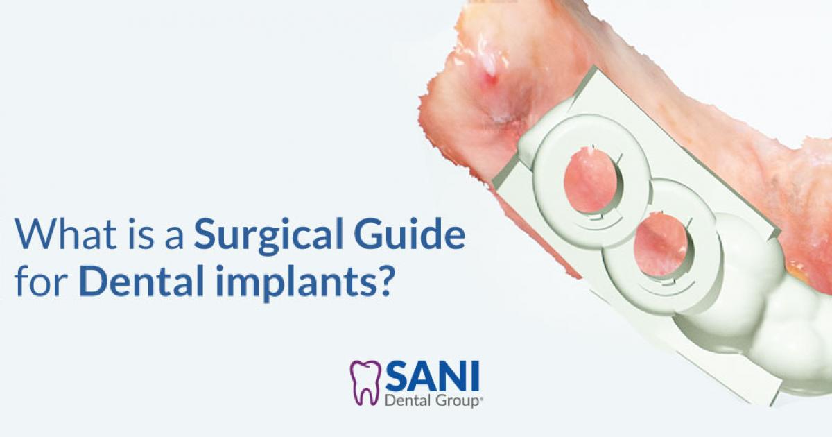 Surgical Guides: A Tool For Better Dental Implants